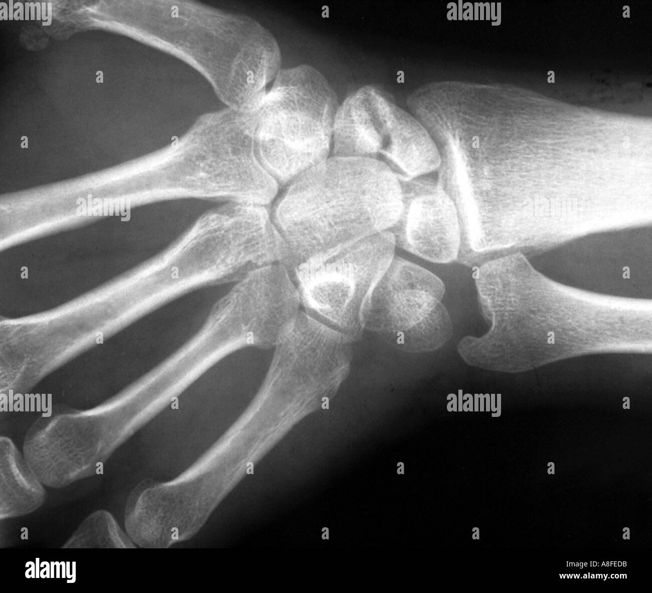 Os scaphoideum hi-res stock photography and images - Alamy