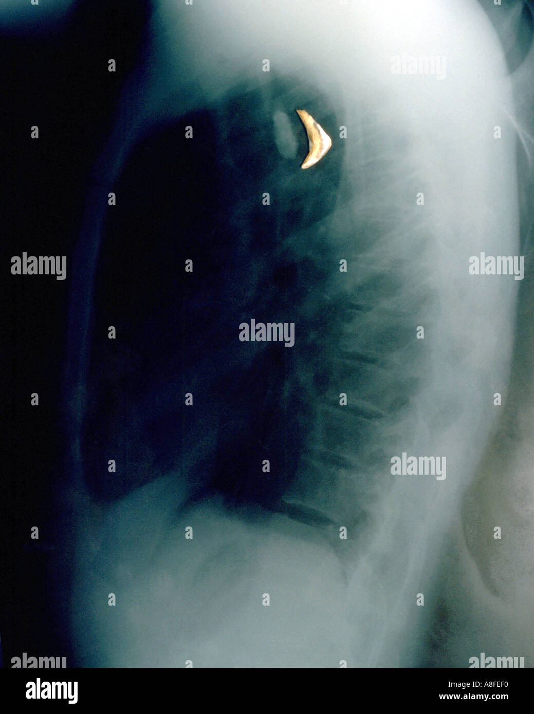 chest x ray Fish Bone in Throat Stock Photo - Alamy