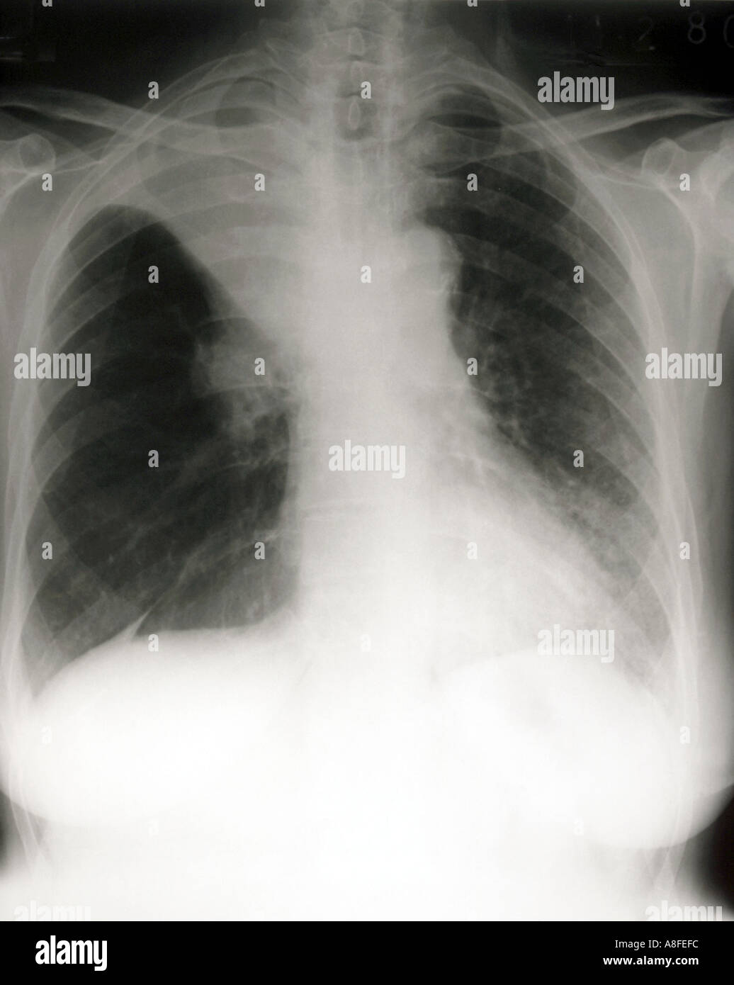 chest x ray Right Upper Lobe Collapse Stock Photo - Alamy chest x ray Right Upper Lobe Collapse Stock Photo - Alamy