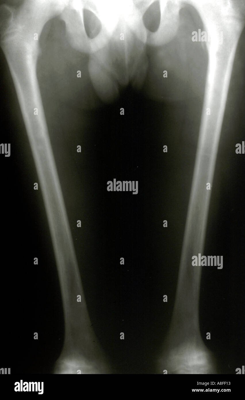 Rickets child hi-res stock photography and images - Alamy