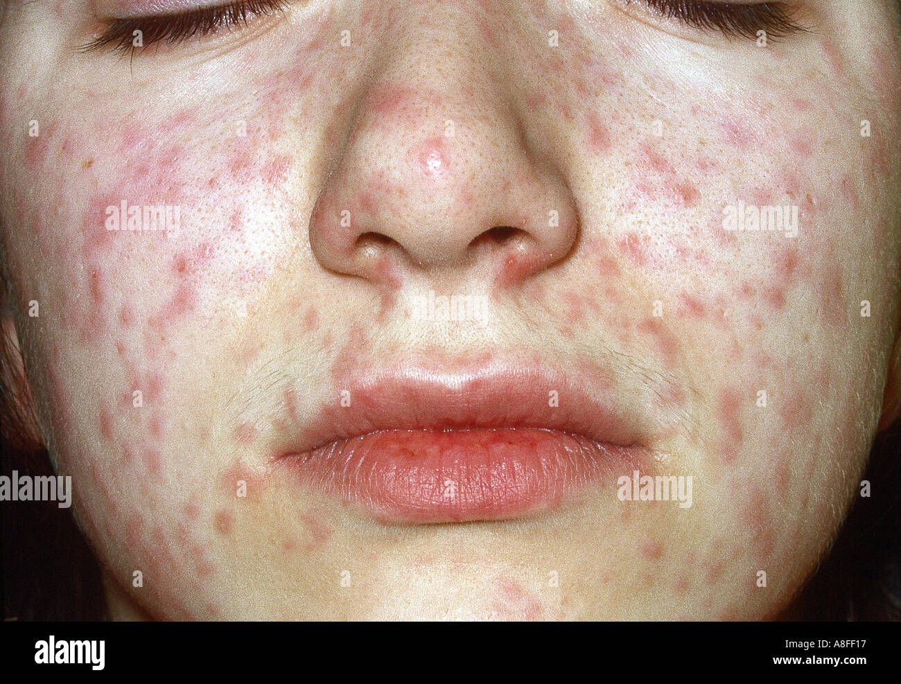 Measles Face