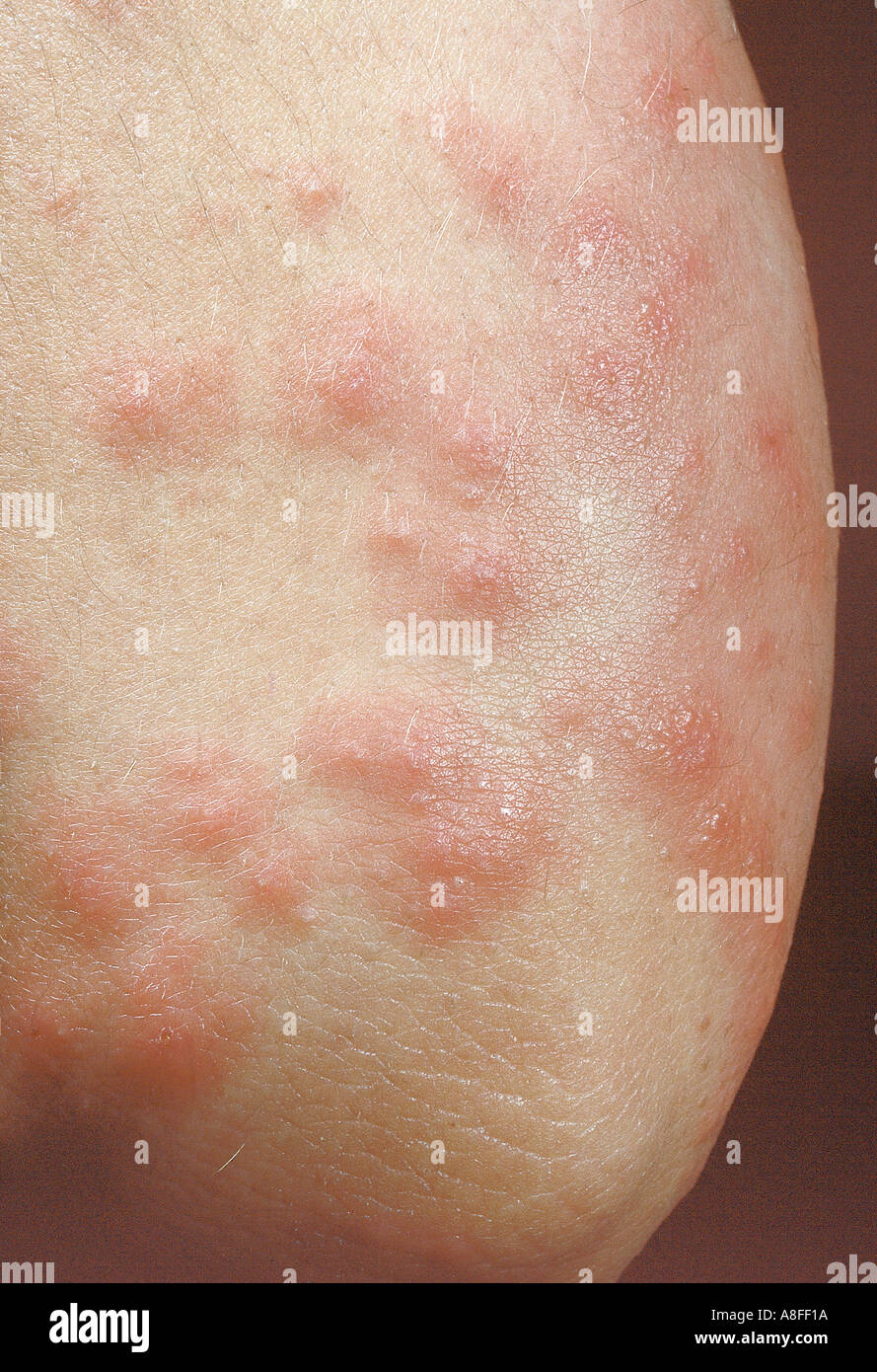 Erythema multiforme hi-res stock photography and images - Alamy