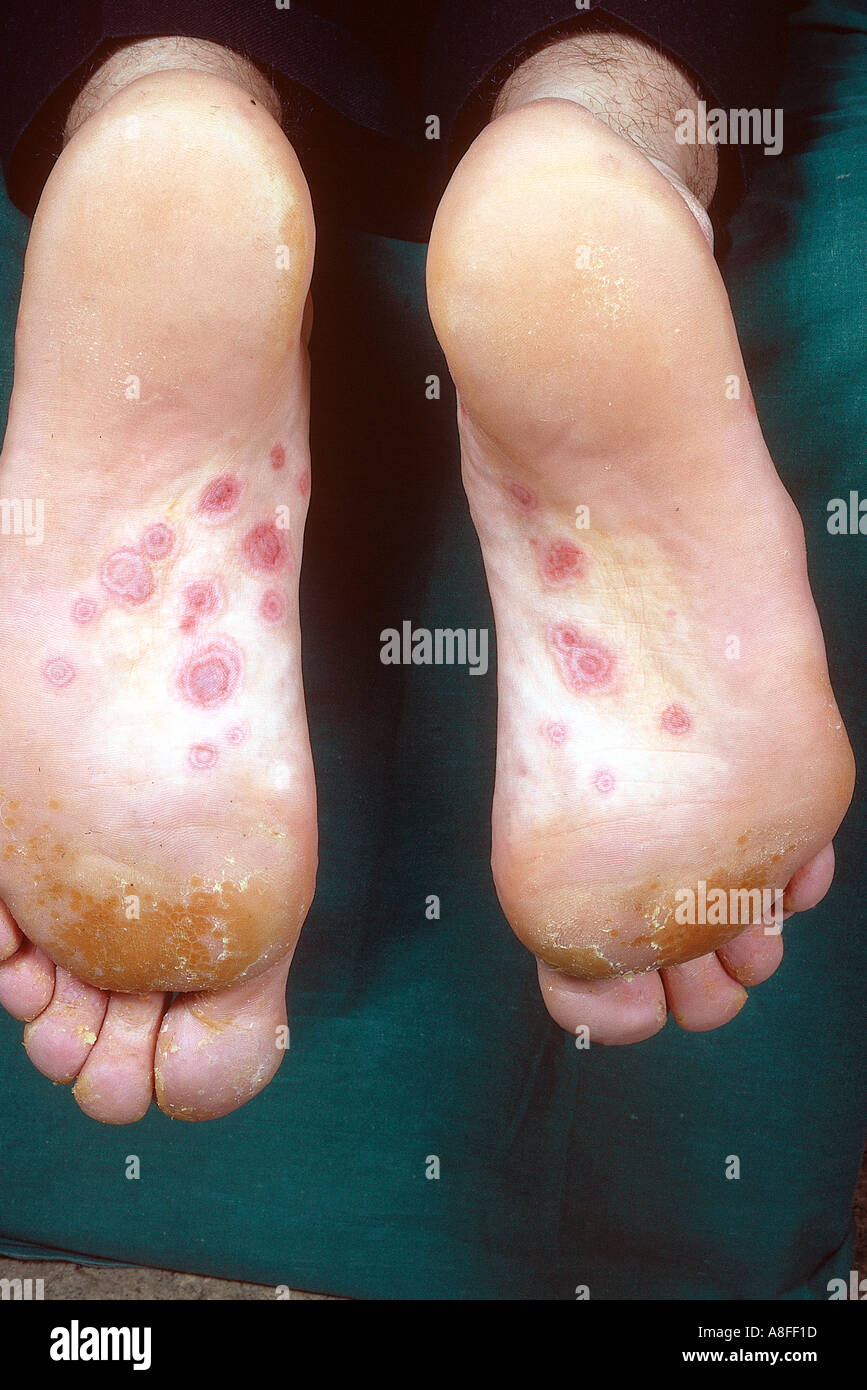 Erythema multiforme hi-res stock photography and images - Alamy