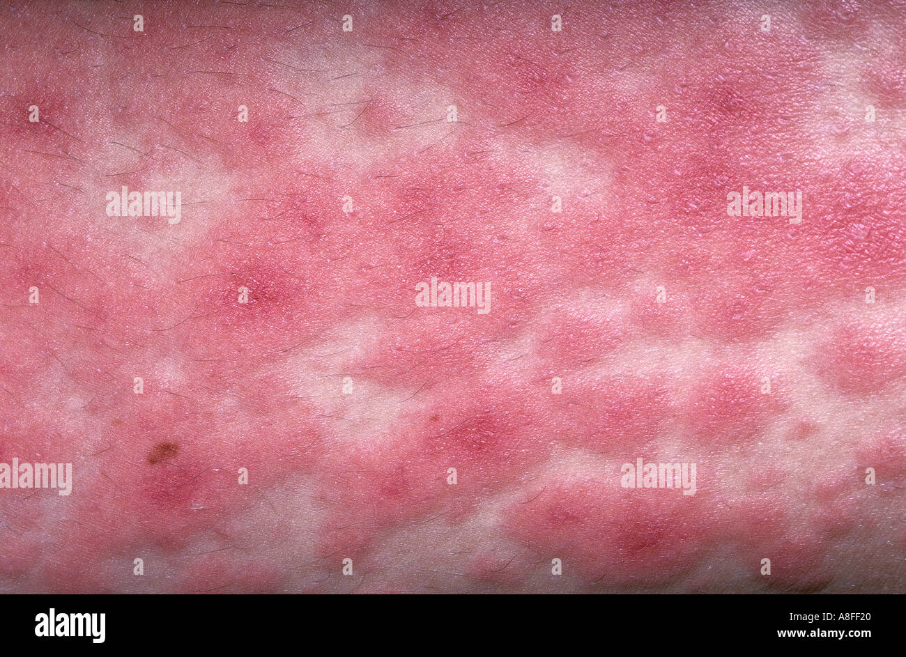 Erythema multiforme Stock Photo - Alamy