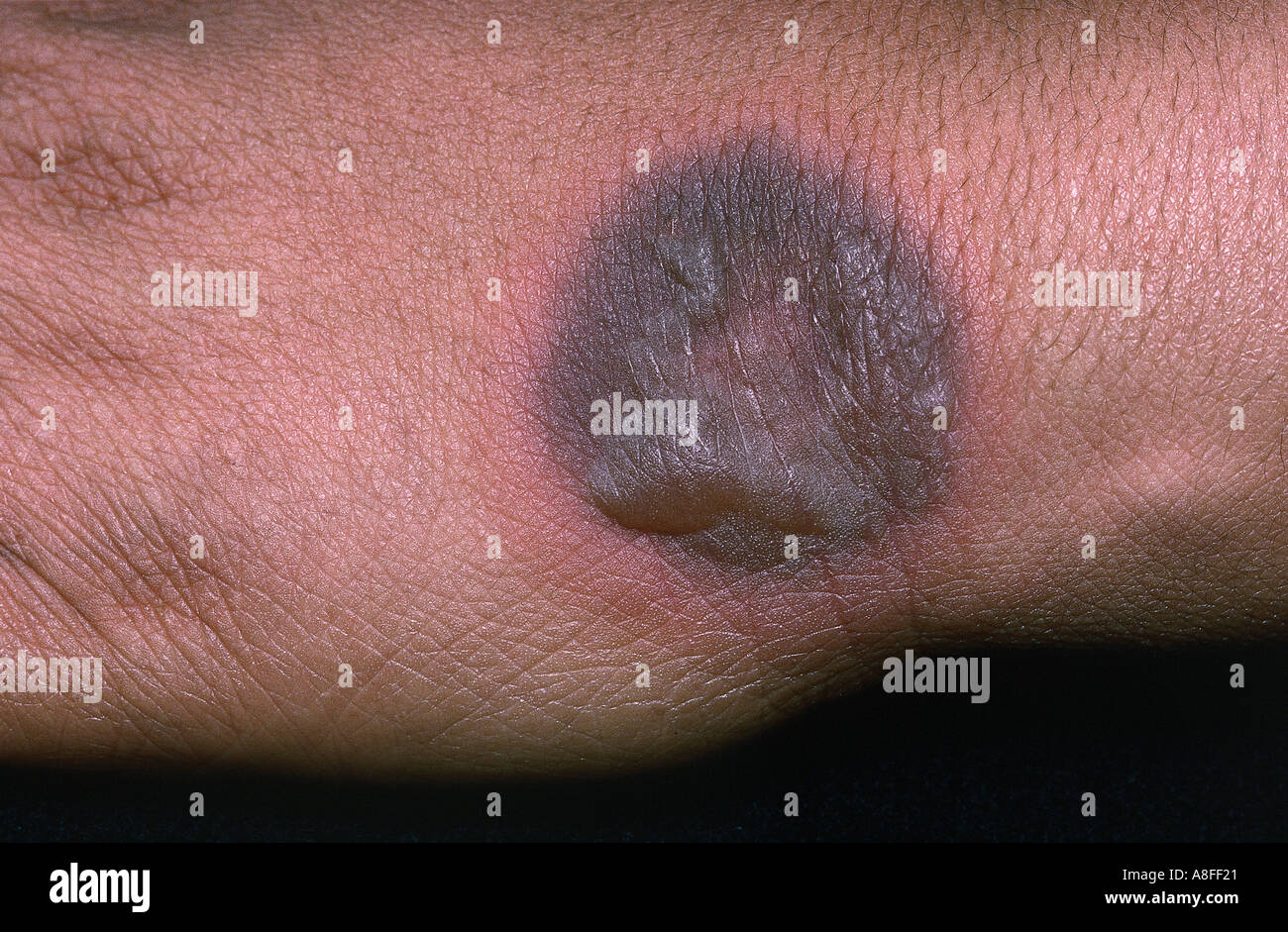 Erythema multiforme hi-res stock photography and images - Alamy