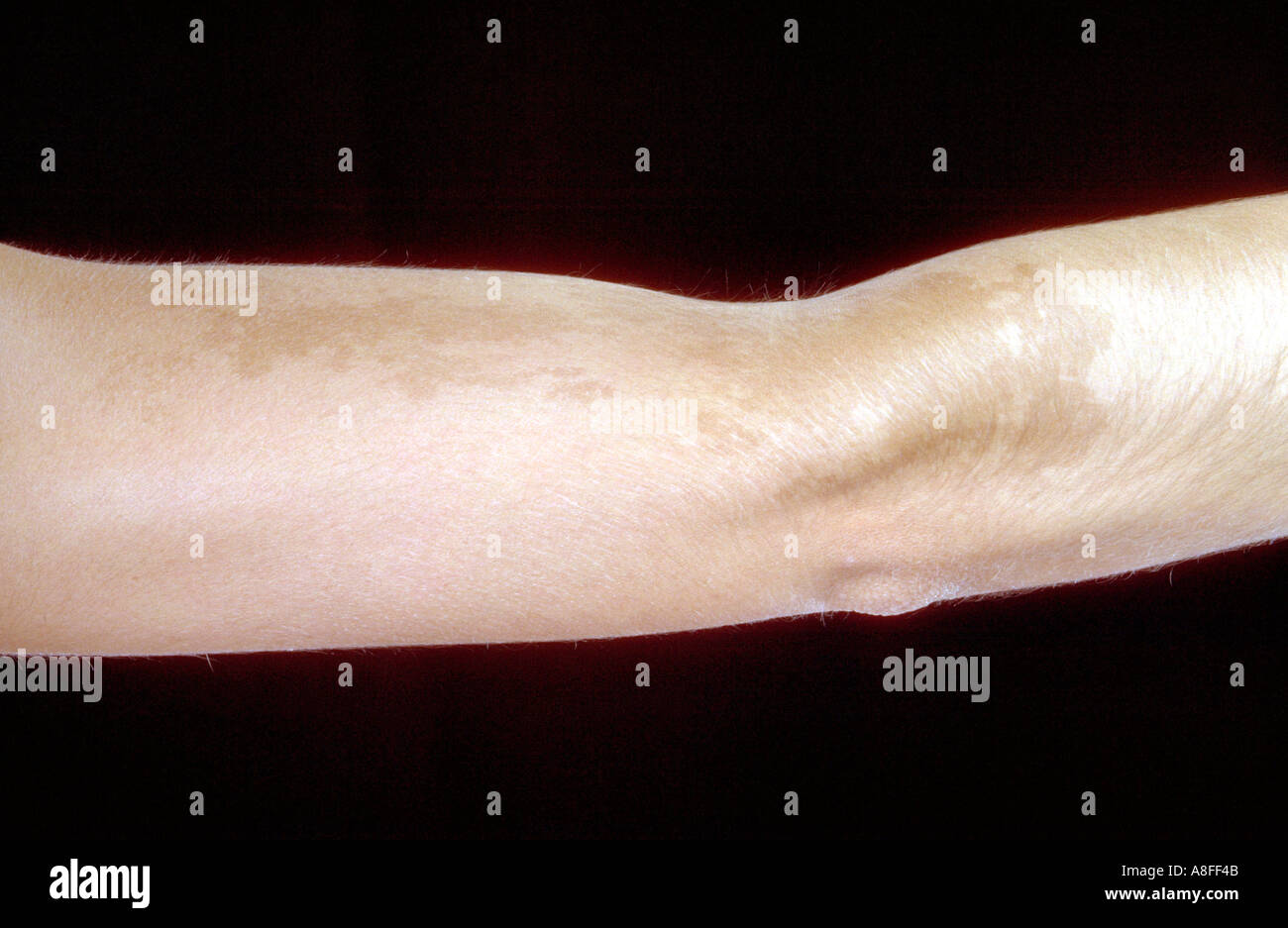 Congenital melanotic naevus Stock Photo - Alamy