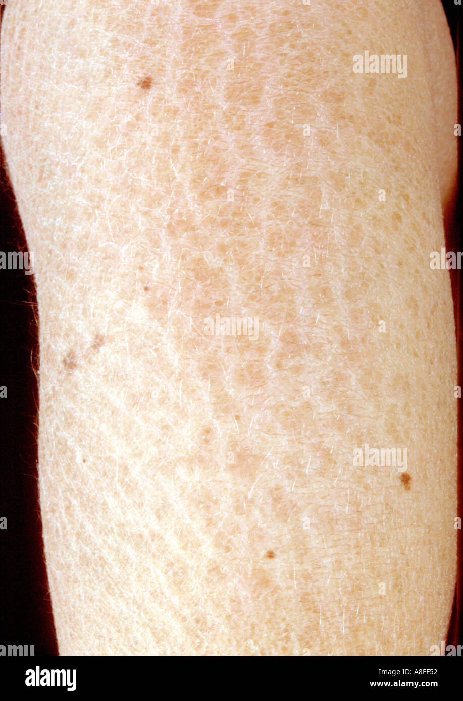 Ichthyosis hi-res stock photography and images - Alamy
