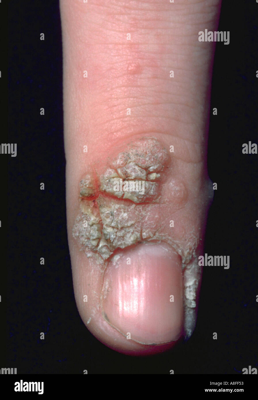 Warts on a finger Stock Photo - Alamy