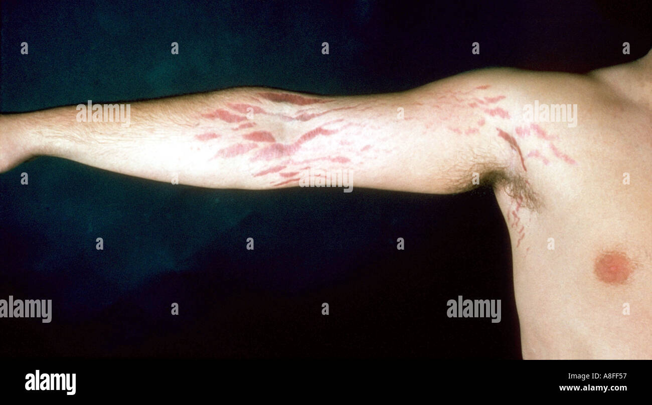 Striae cushings syndrome Stock Photo - Alamy