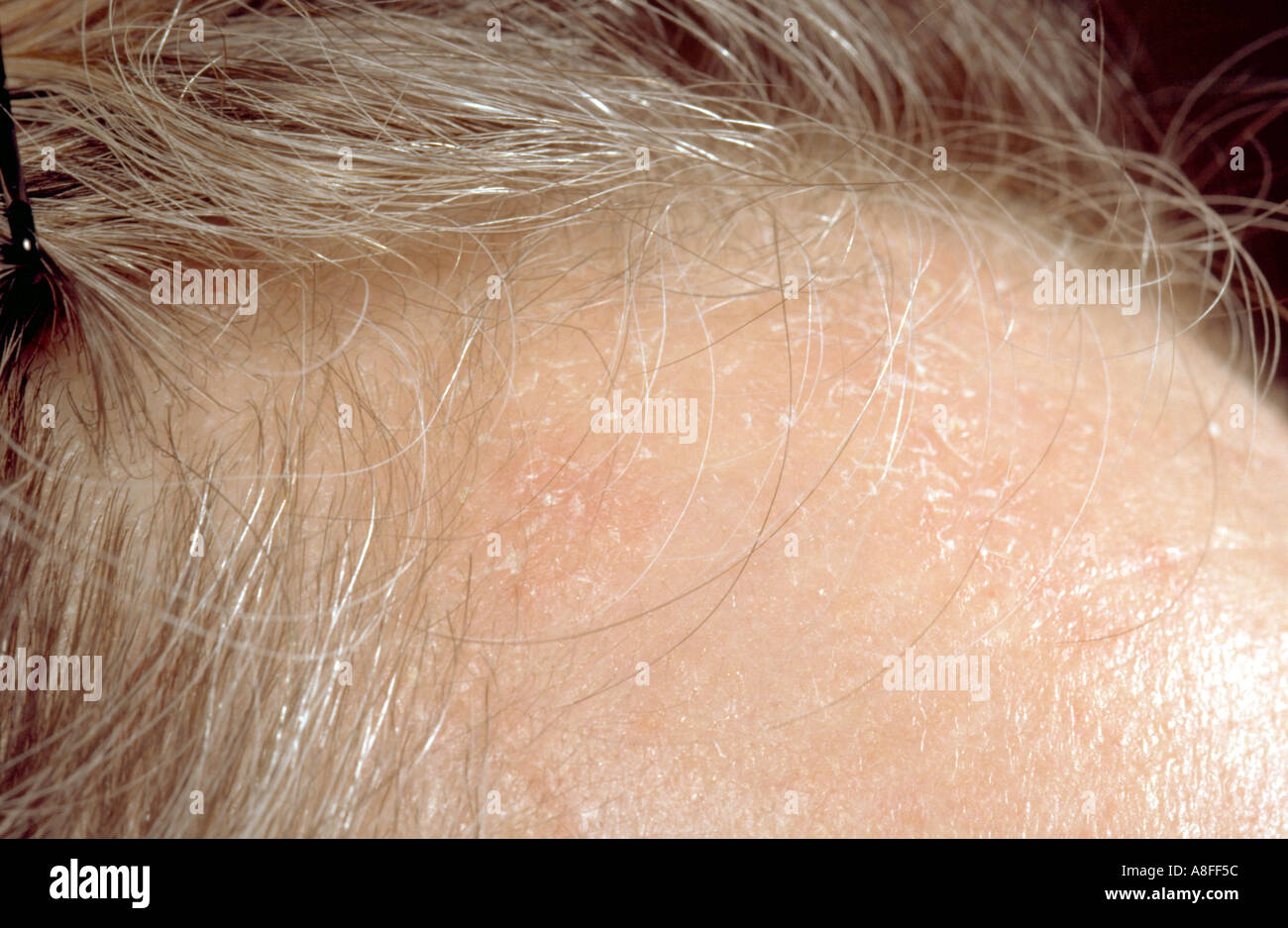 Seborrhea dermatitis hi-res stock photography and images - Alamy