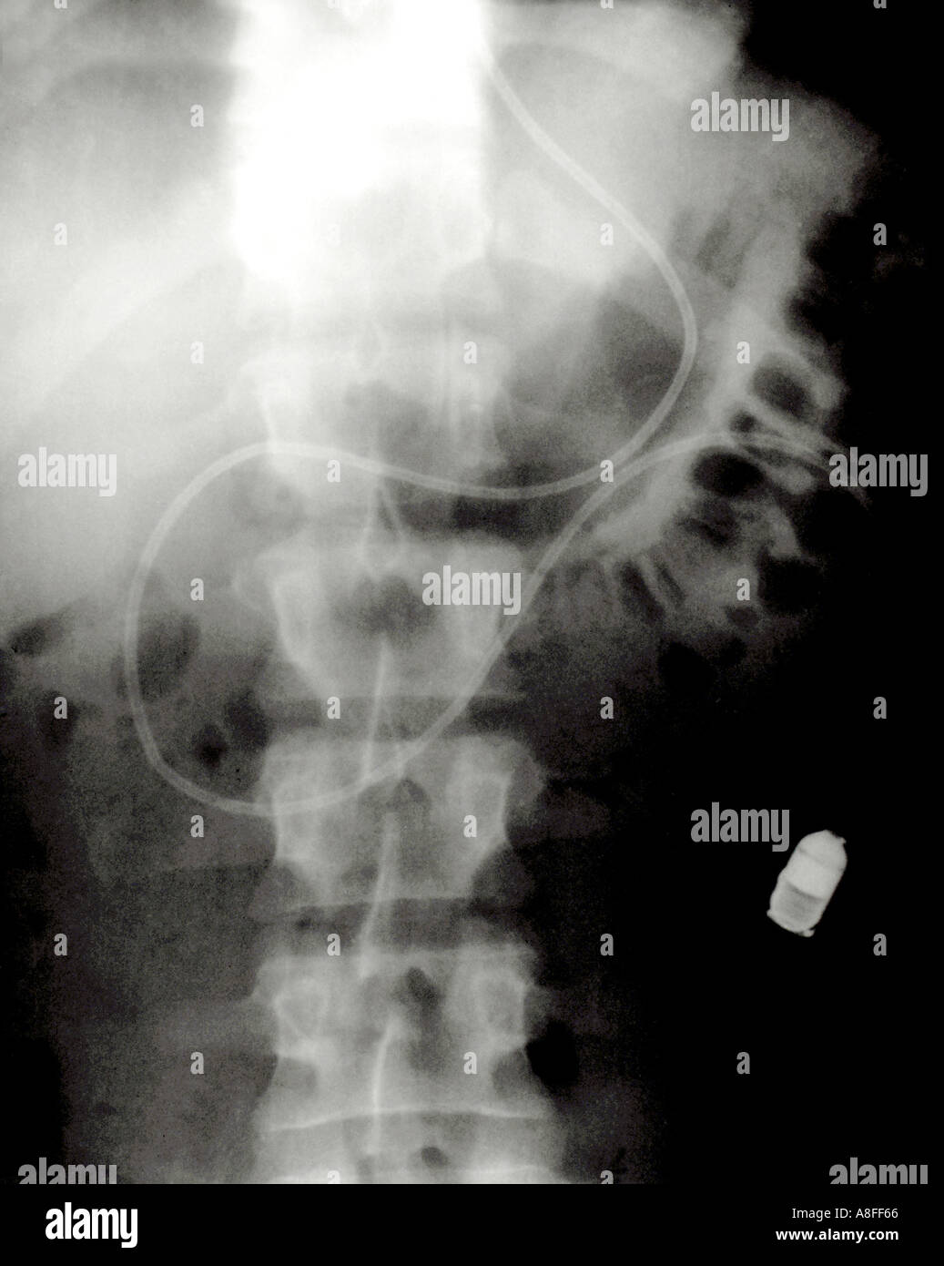 Intestinal biopsy with Crosby Kugler capsule Stock Photo - Alamy