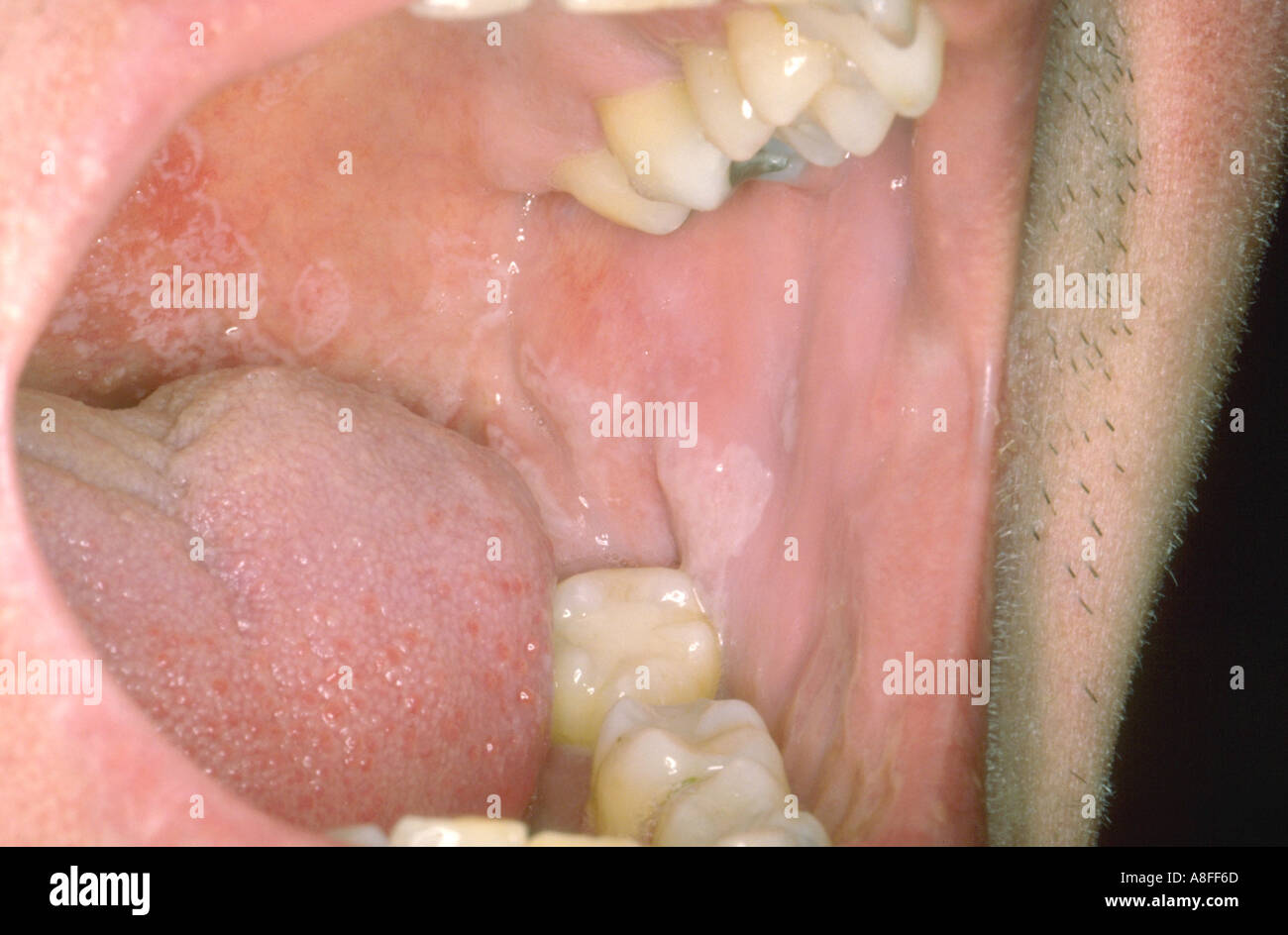 Buccal cavity hi-res stock photography and images - Alamy