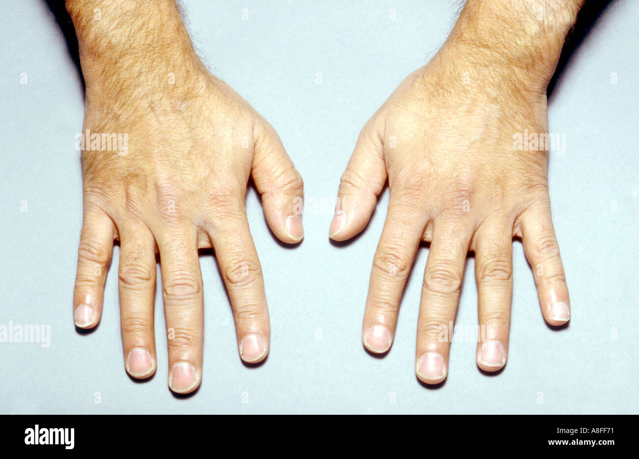 Xanthomata Stock Photo - Alamy