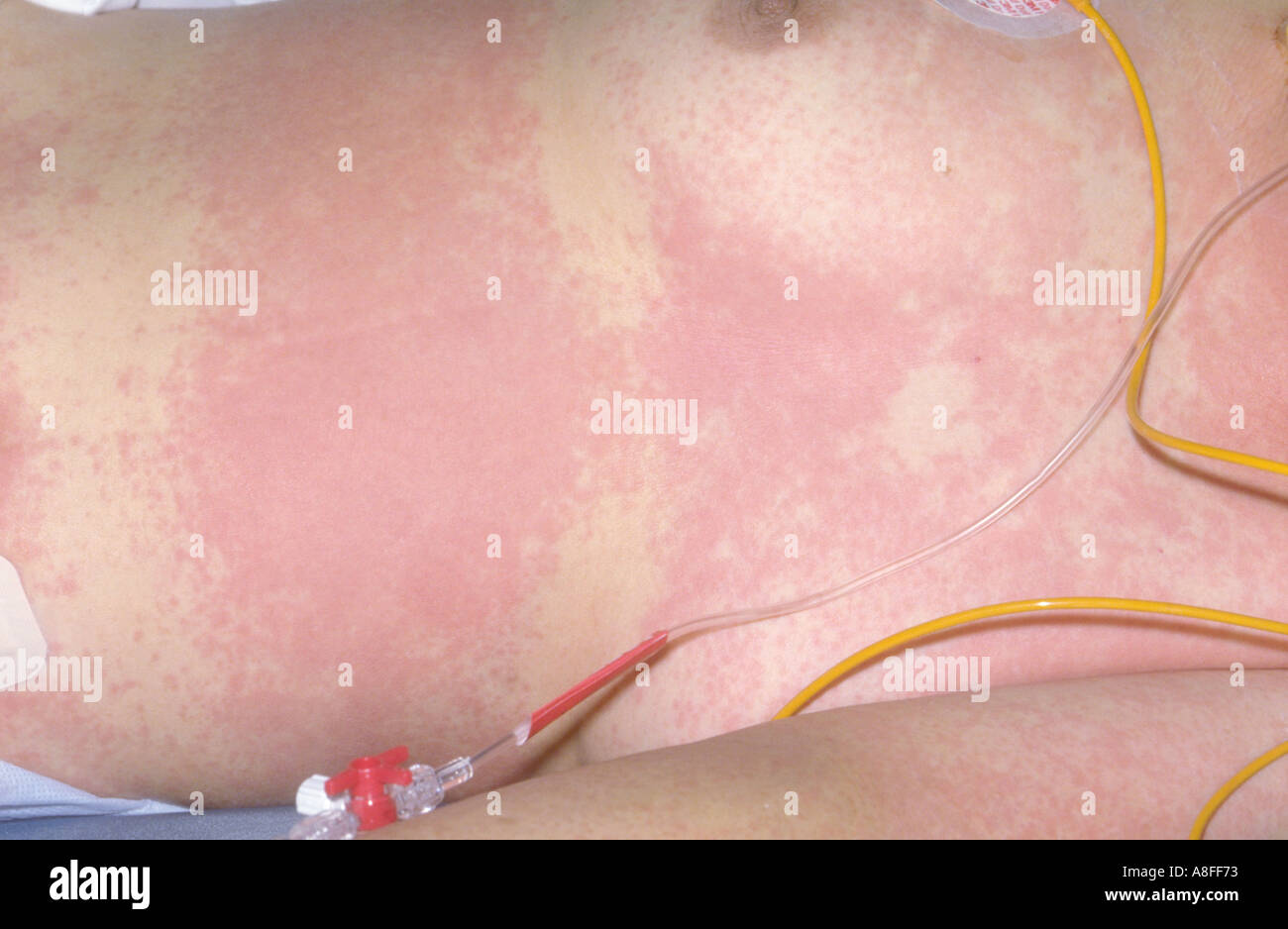 Child measles rash hi-res stock photography and images - Alamy