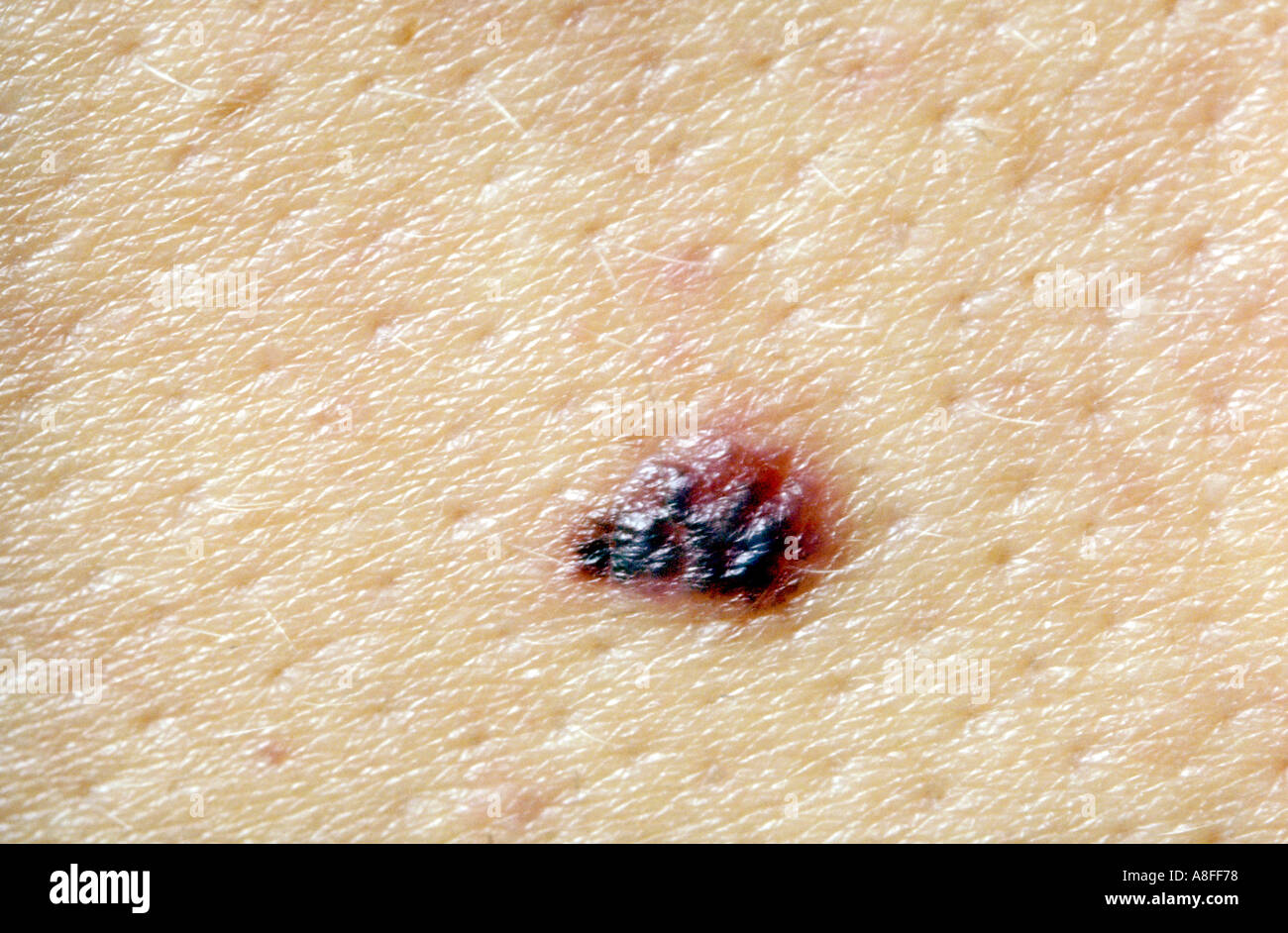 Intradermal nevus hi-res stock photography and images - Alamy