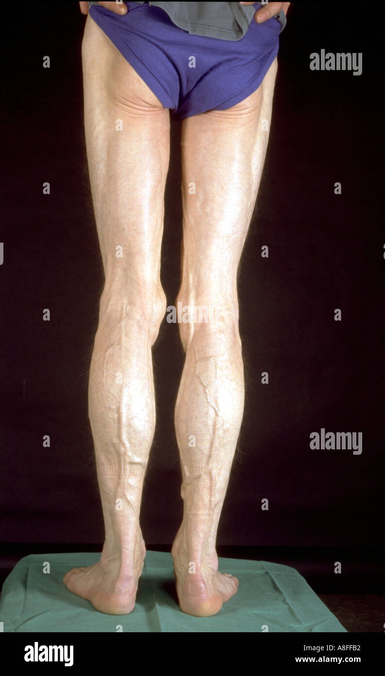 Hiv lipodystrophy hi-res stock photography and images - Alamy