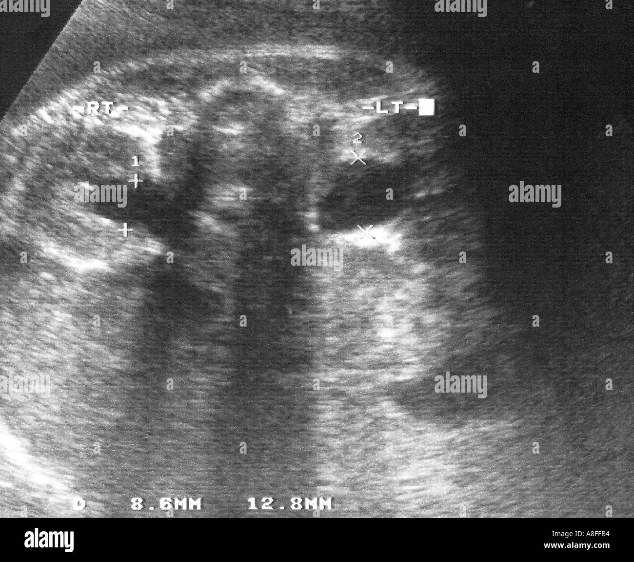 Ultrasound scan hydronephrosis Stock Photo - Alamy