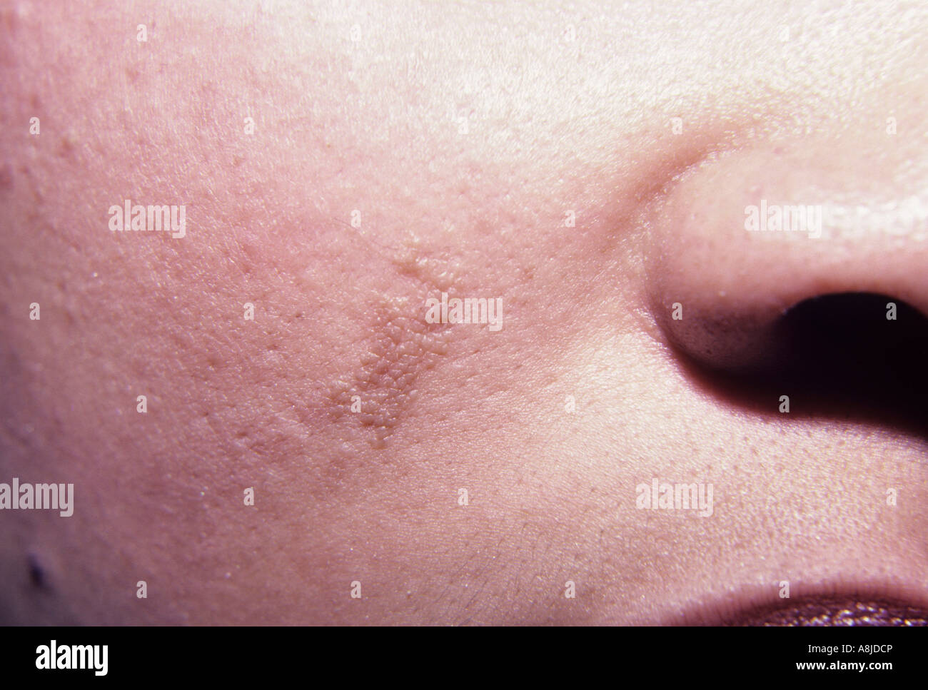 Scar on woman's cheek Stock Photo - Alamy