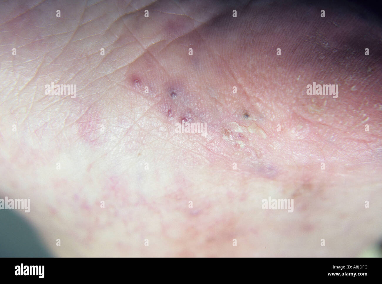 The heals, soles and sides of the foot show a faint pink color covered ...