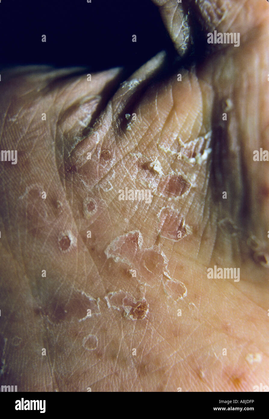 Scalp problems hi-res stock photography and images - Alamy