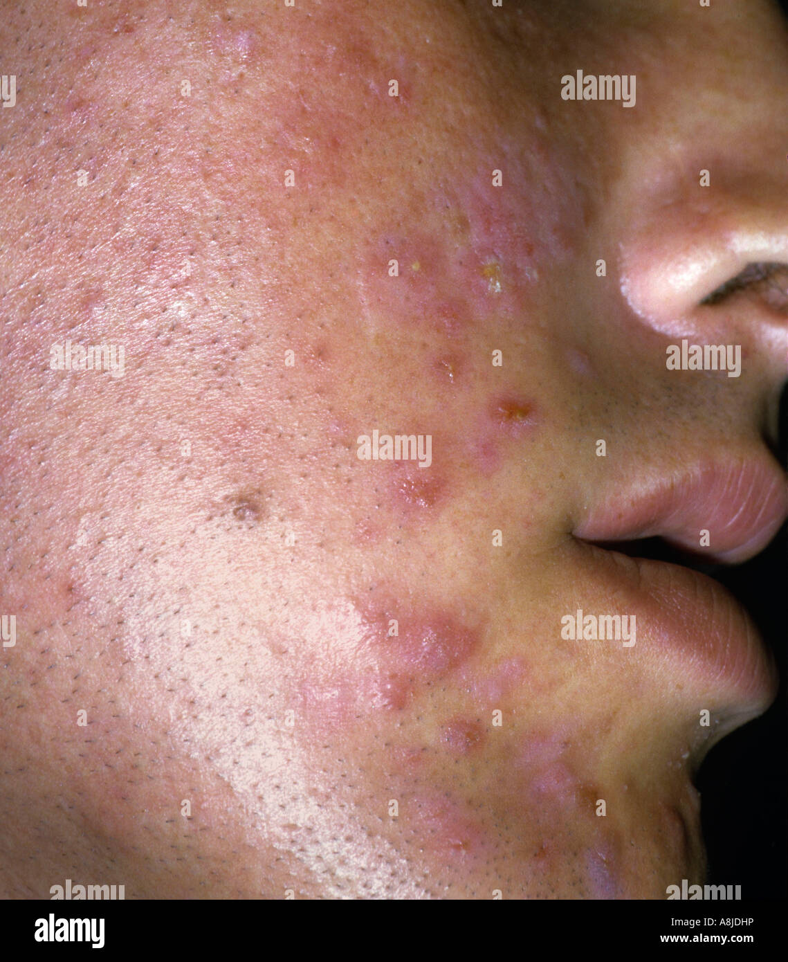 Cysts acne hi-res stock photography and images - Alamy