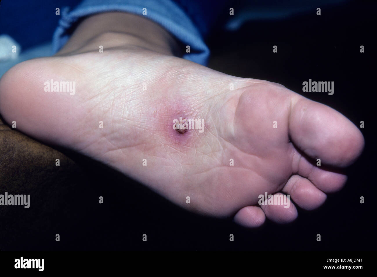 Patient with common skin disease caused by a virus Stock Photo - Alamy