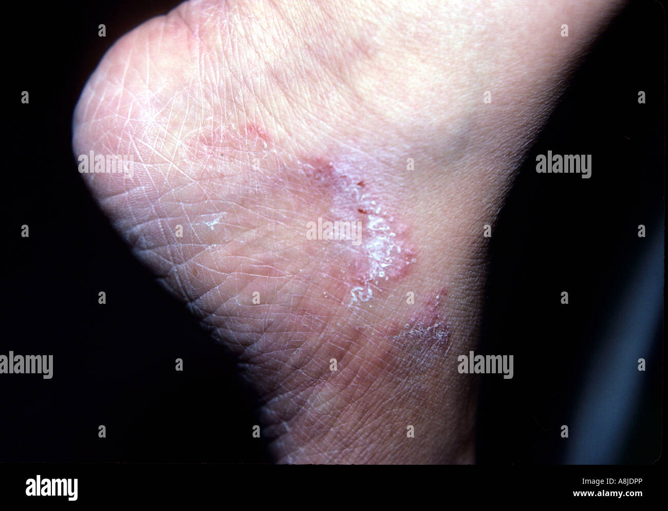 Fungal infection rash (tinea) on patient's ankle Stock Photo - Alamy