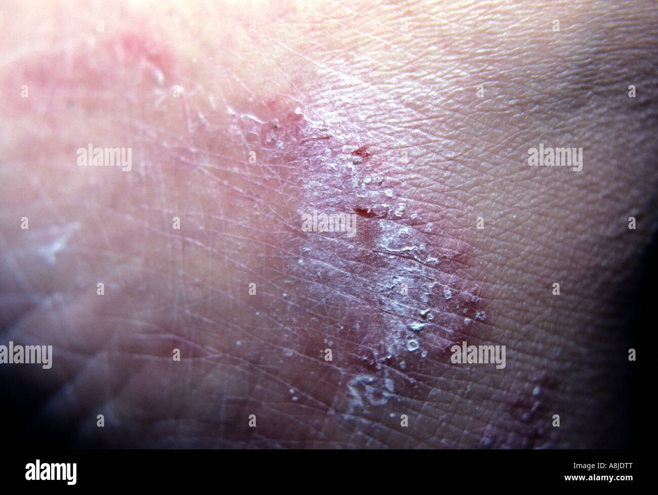 Athletes foot caused by tinea pedis. Dry cracked heal on the sole of ...