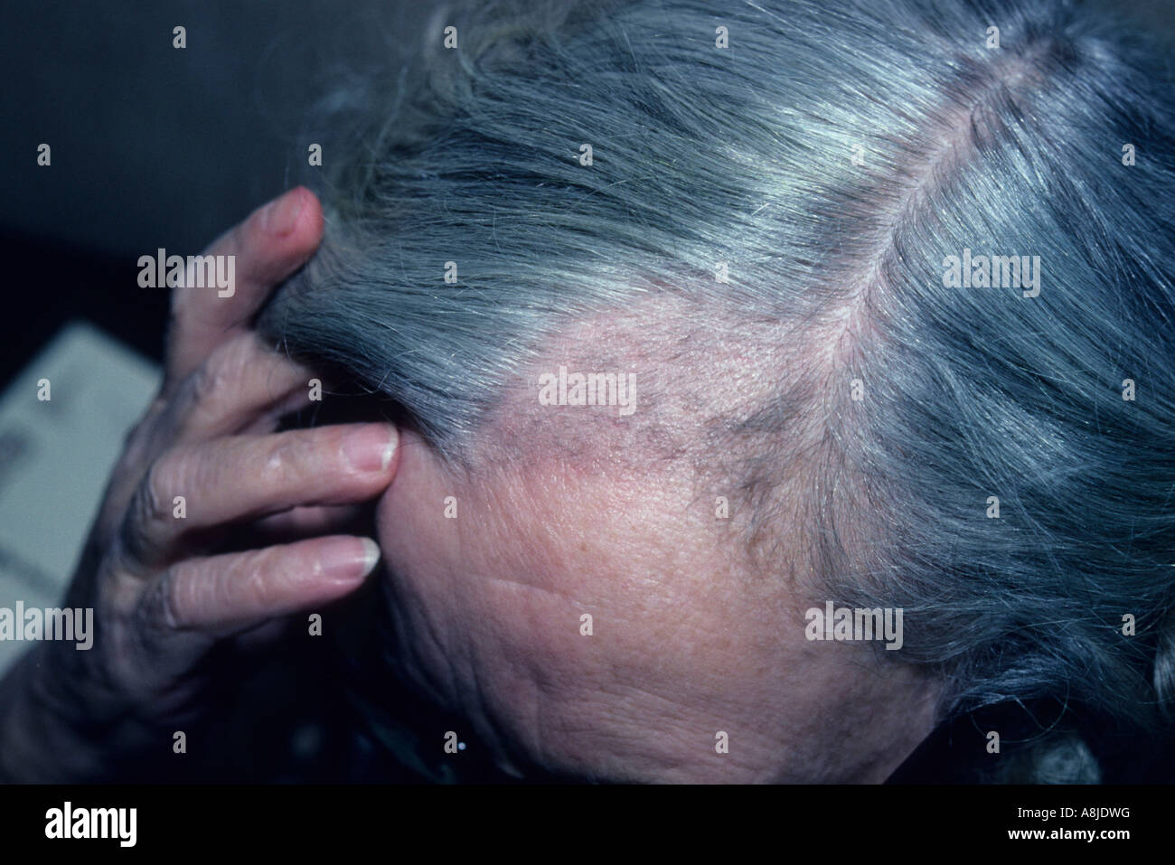 Alopecia areata hair loss hi-res stock photography and images - Alamy