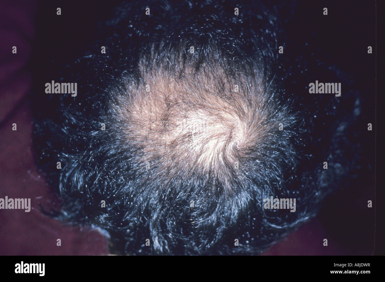 Alopecia areata is a localized loss of hair Stock Photo - Alamy