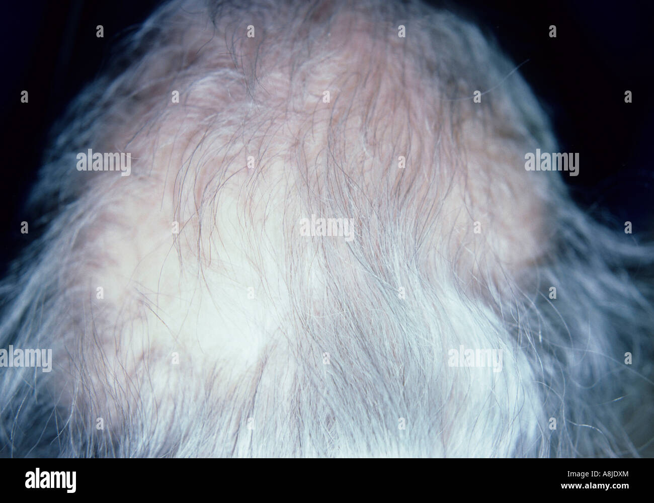 Alopecia areata hi-res stock photography and images - Alamy
