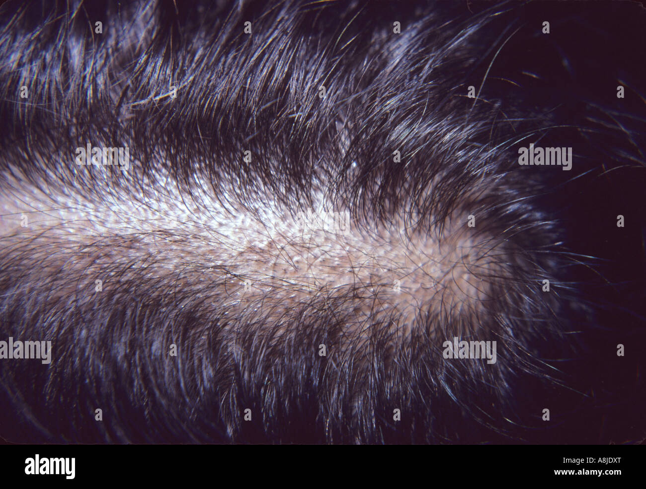 Alopecia areata, as seen on the head of a patient Stock Photo - Alamy