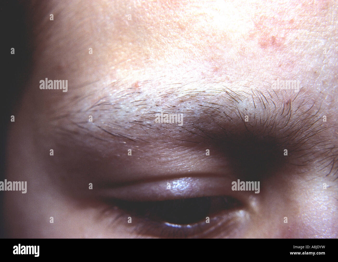 Alopecia areata. The premature loss of hair. Patches of hair loss is ...