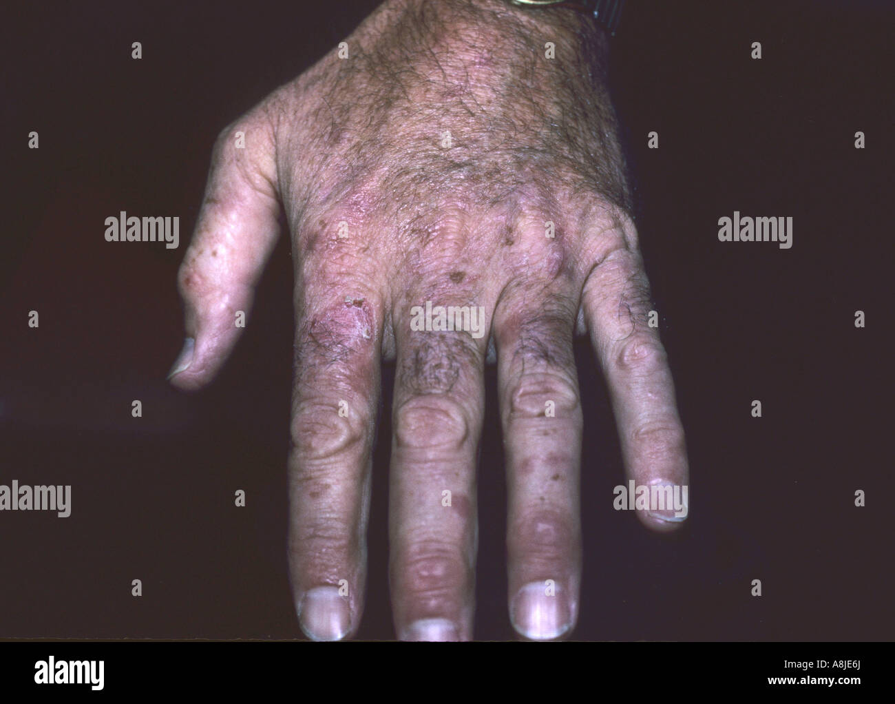 Porphyria porphyria hi-res stock photography and images - Alamy