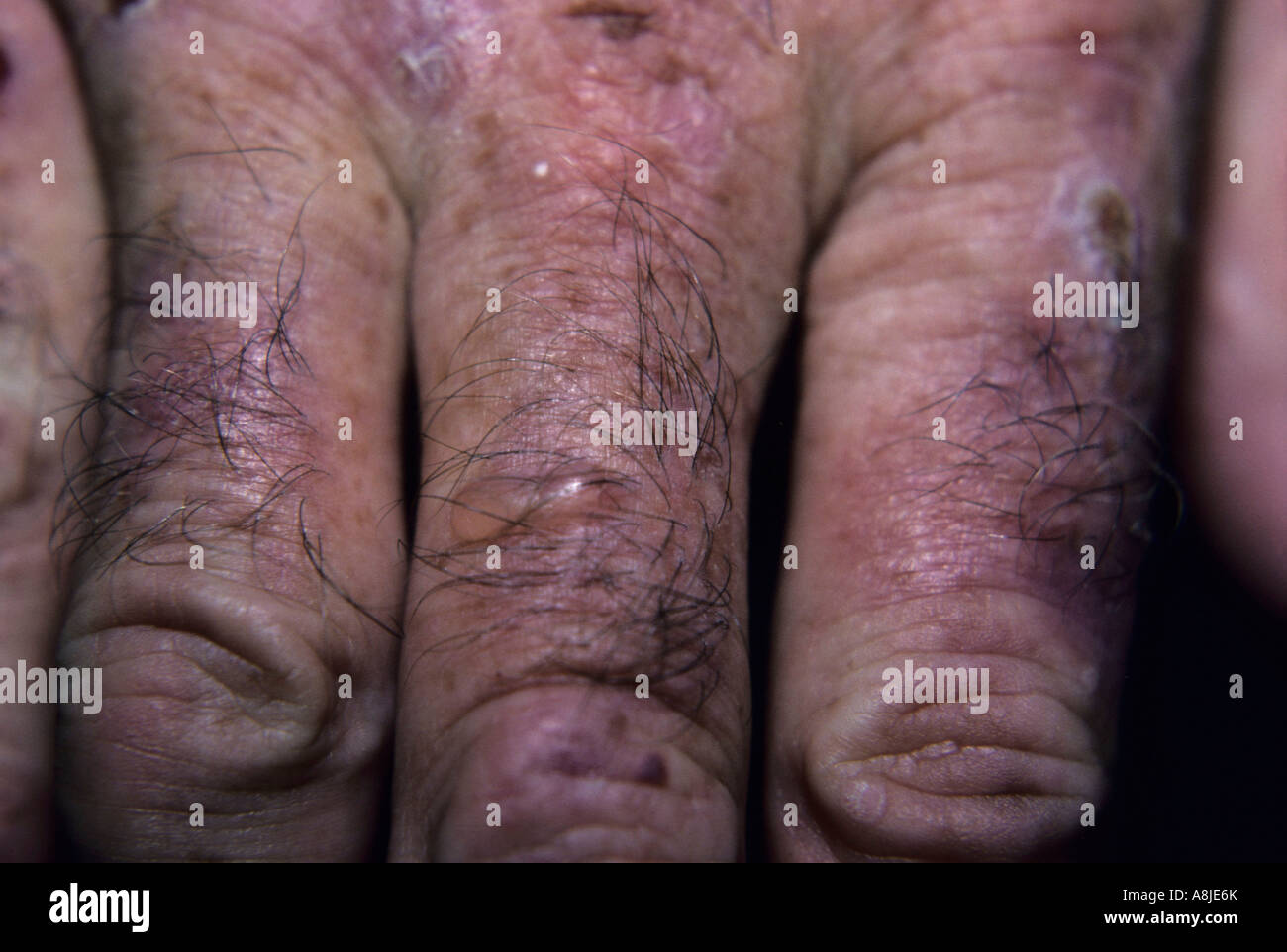 Porphyria porphyria hi-res stock photography and images - Alamy