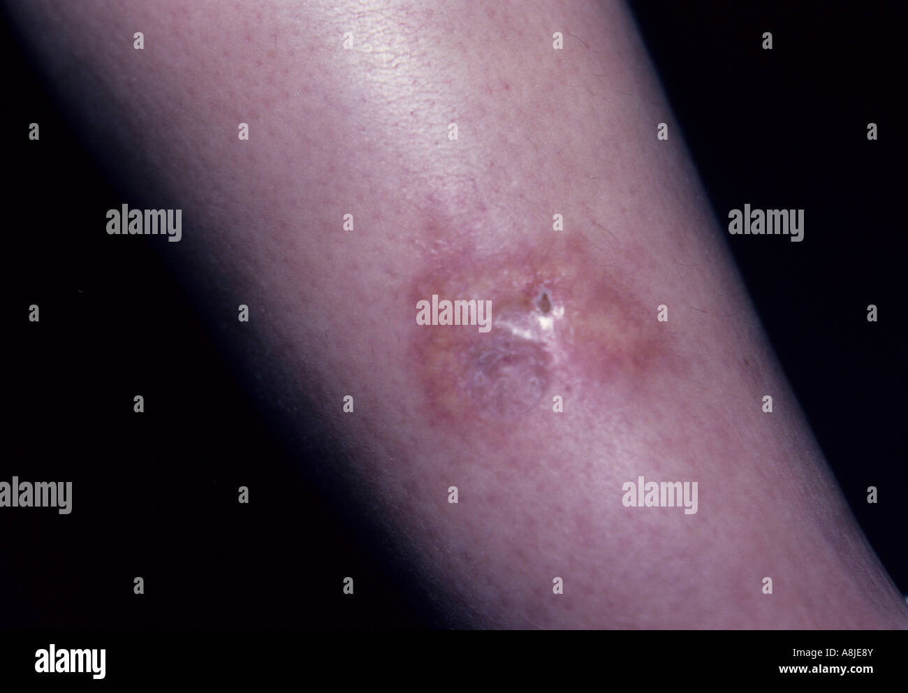 Necrobiosis Lipoidica Diabeticorum Histology