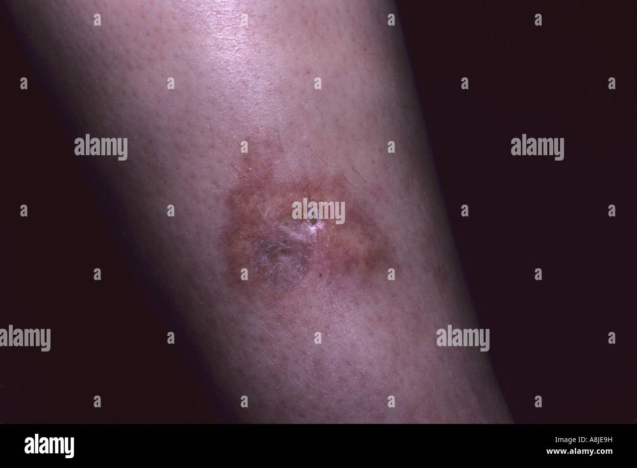 Necrobiosis lipoidica hi-res stock photography and images - Alamy