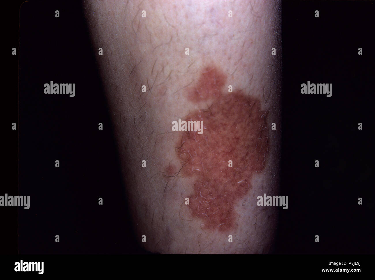 Necrobiosis lipoidica diabeticorum is a rash which usually occurs on ...