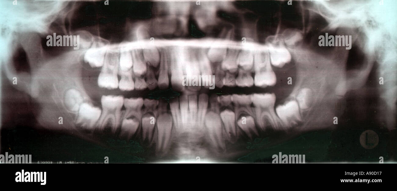 x-ray of the set of teeth of a 12 year old girl Stock Photo - Alamy