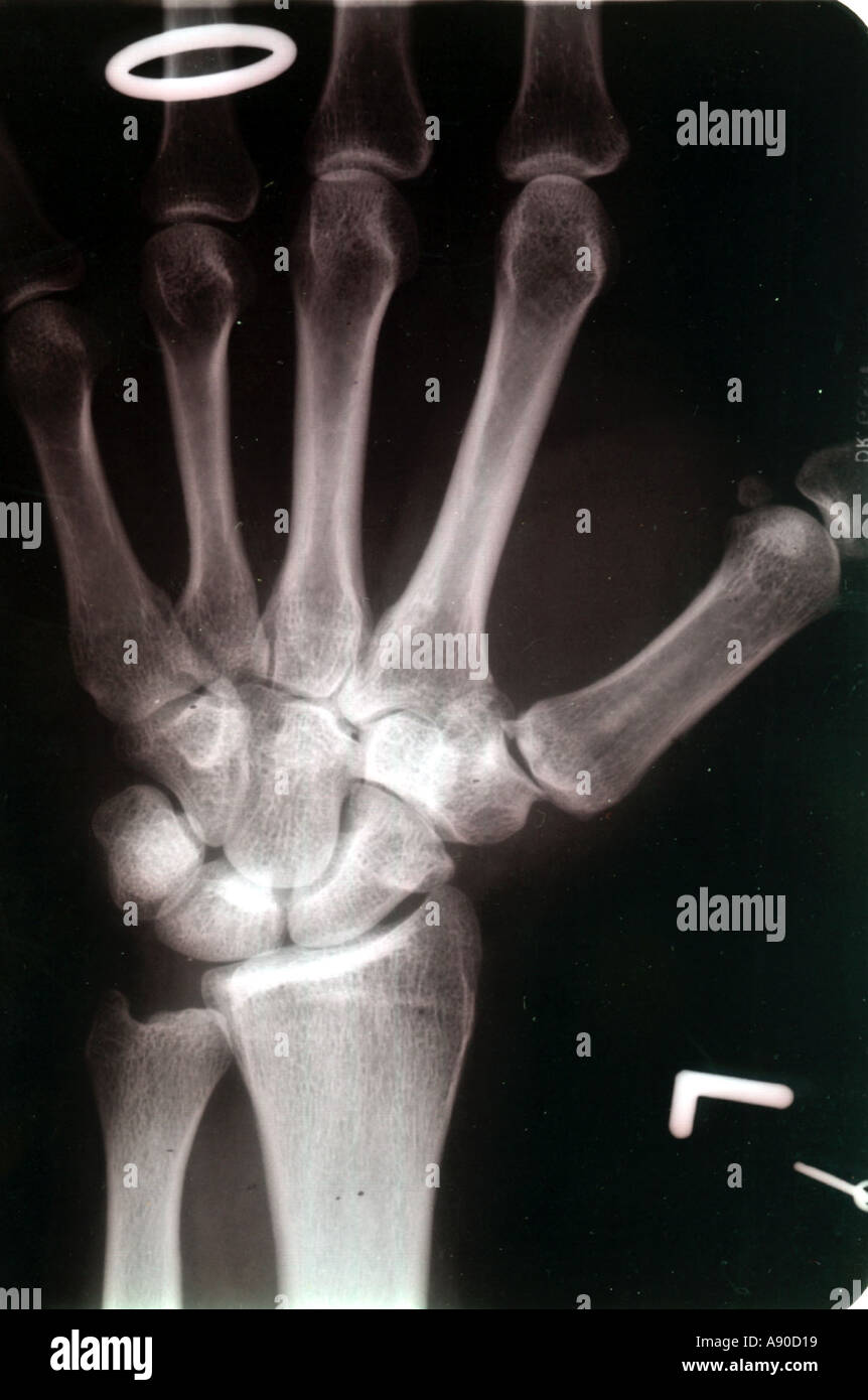 Dislocated finger High Resolution Stock Photography and Images - Alamy