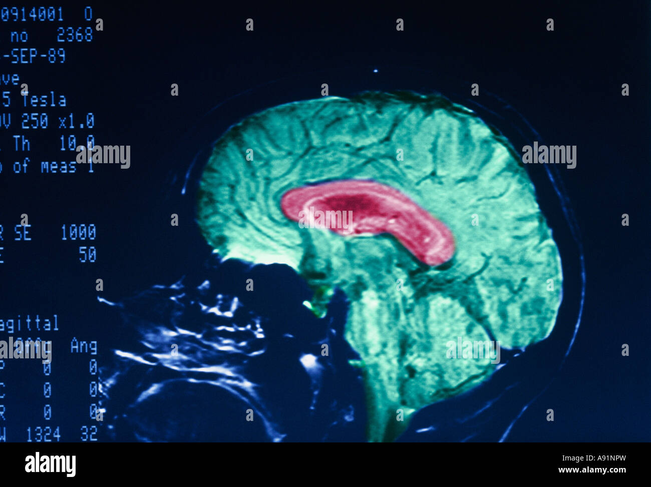 Mri of healthy brain hi-res stock photography and images - Alamy