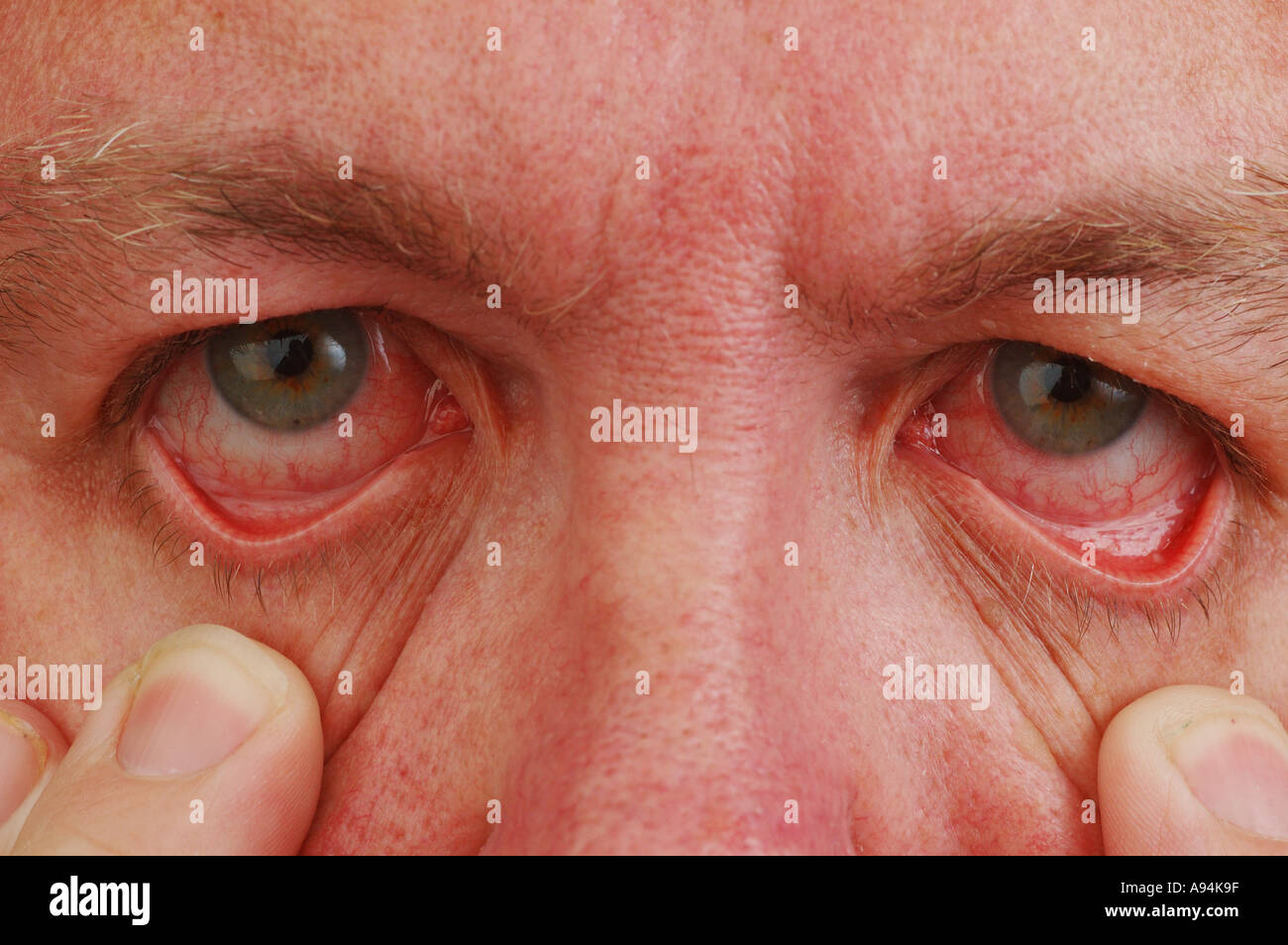 Bloodshot Eyes Stock Photos & Bloodshot Eyes Stock Images - Alamy