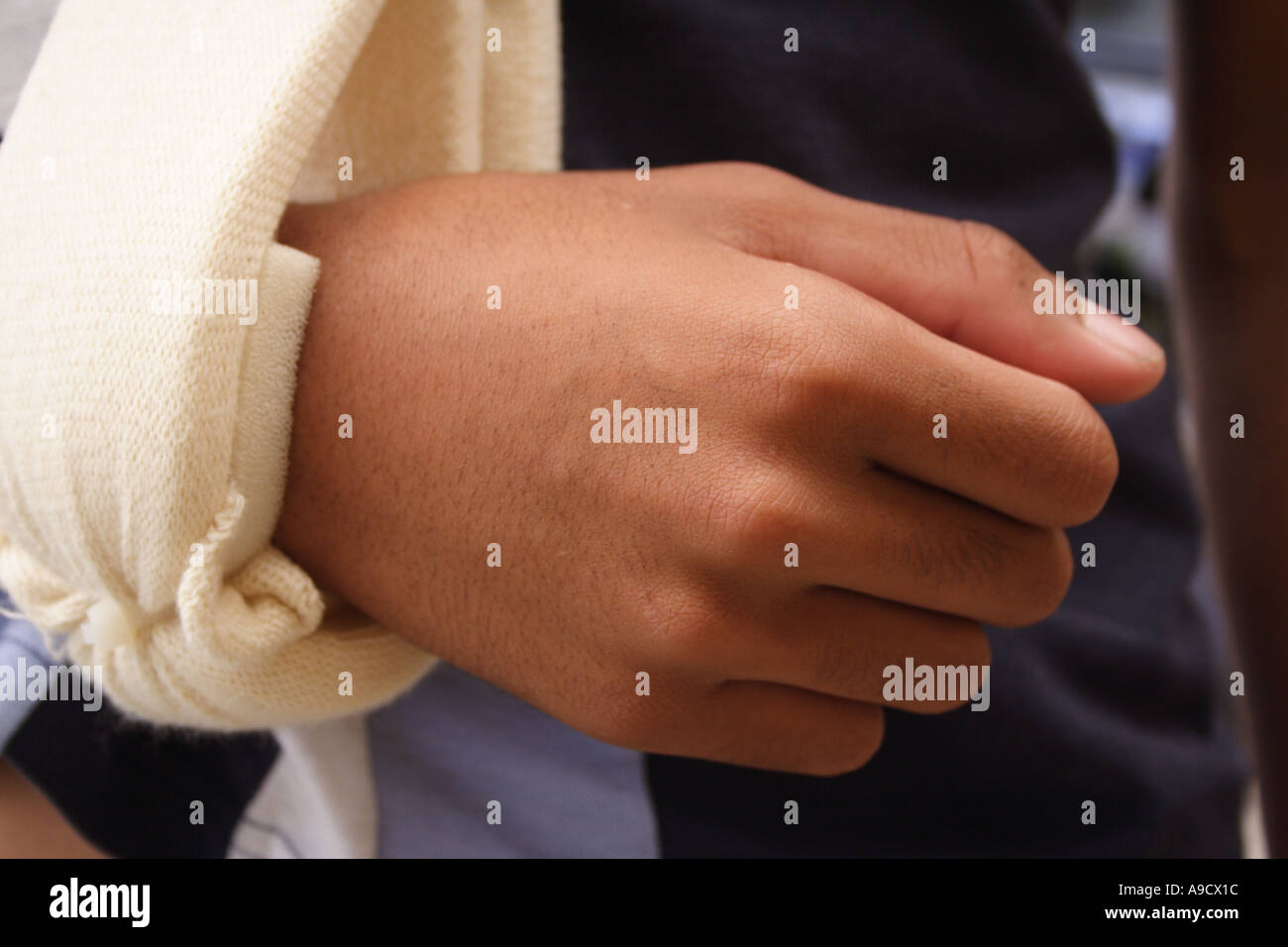 HAND IN A SLING BAPD1545 Stock Photo - Alamy