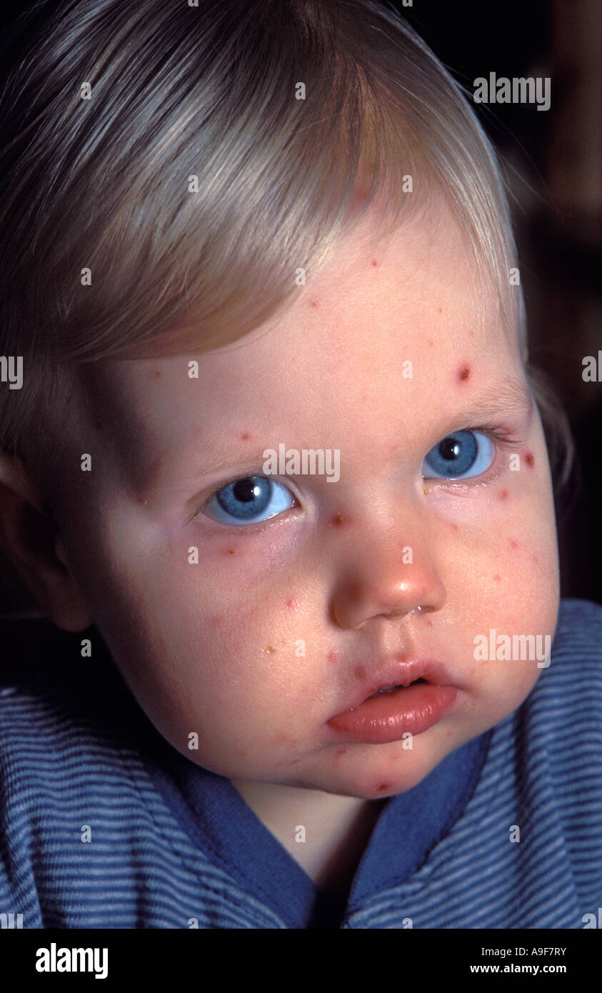 Chicken Pox Day 2