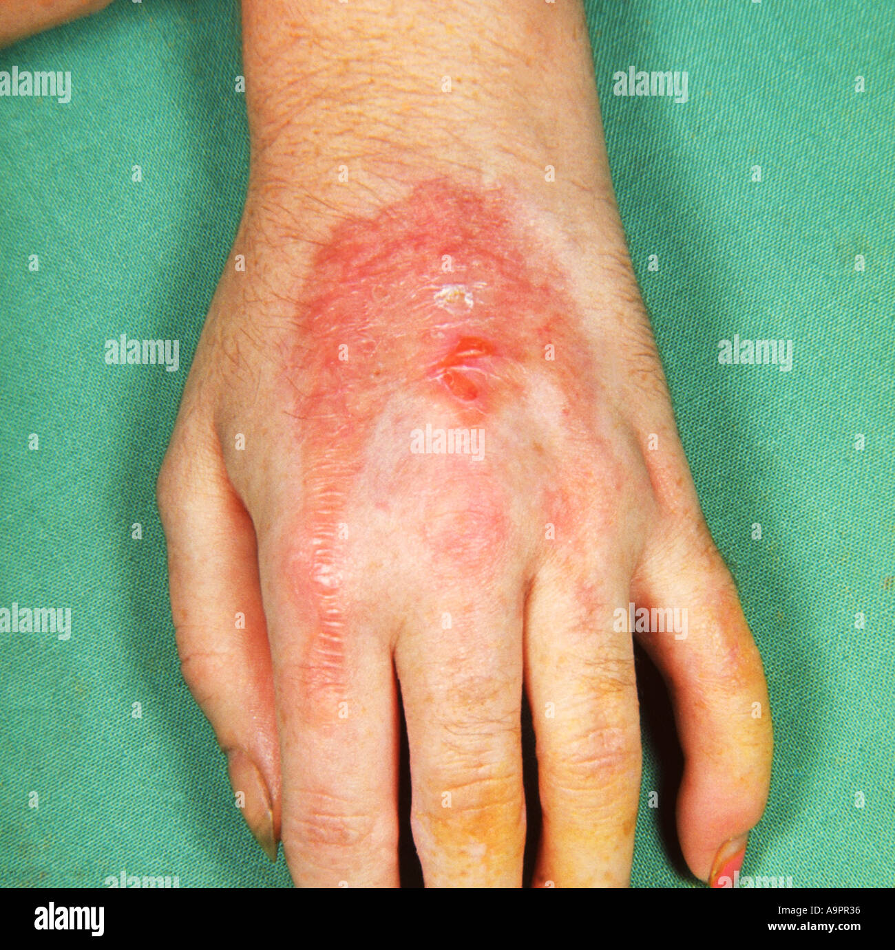 Burn Stock Photo - Alamy