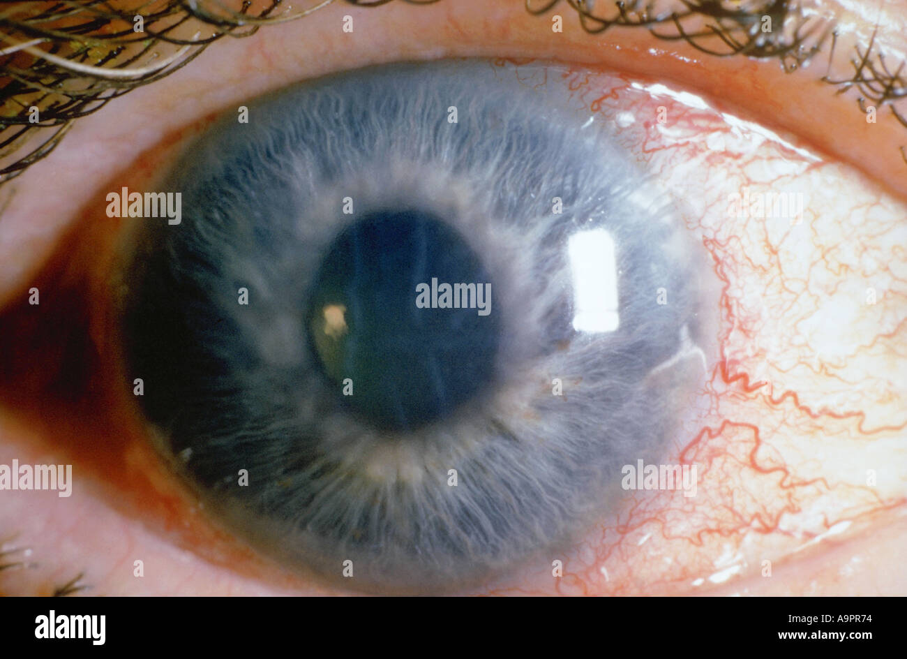 Acute Glaucoma