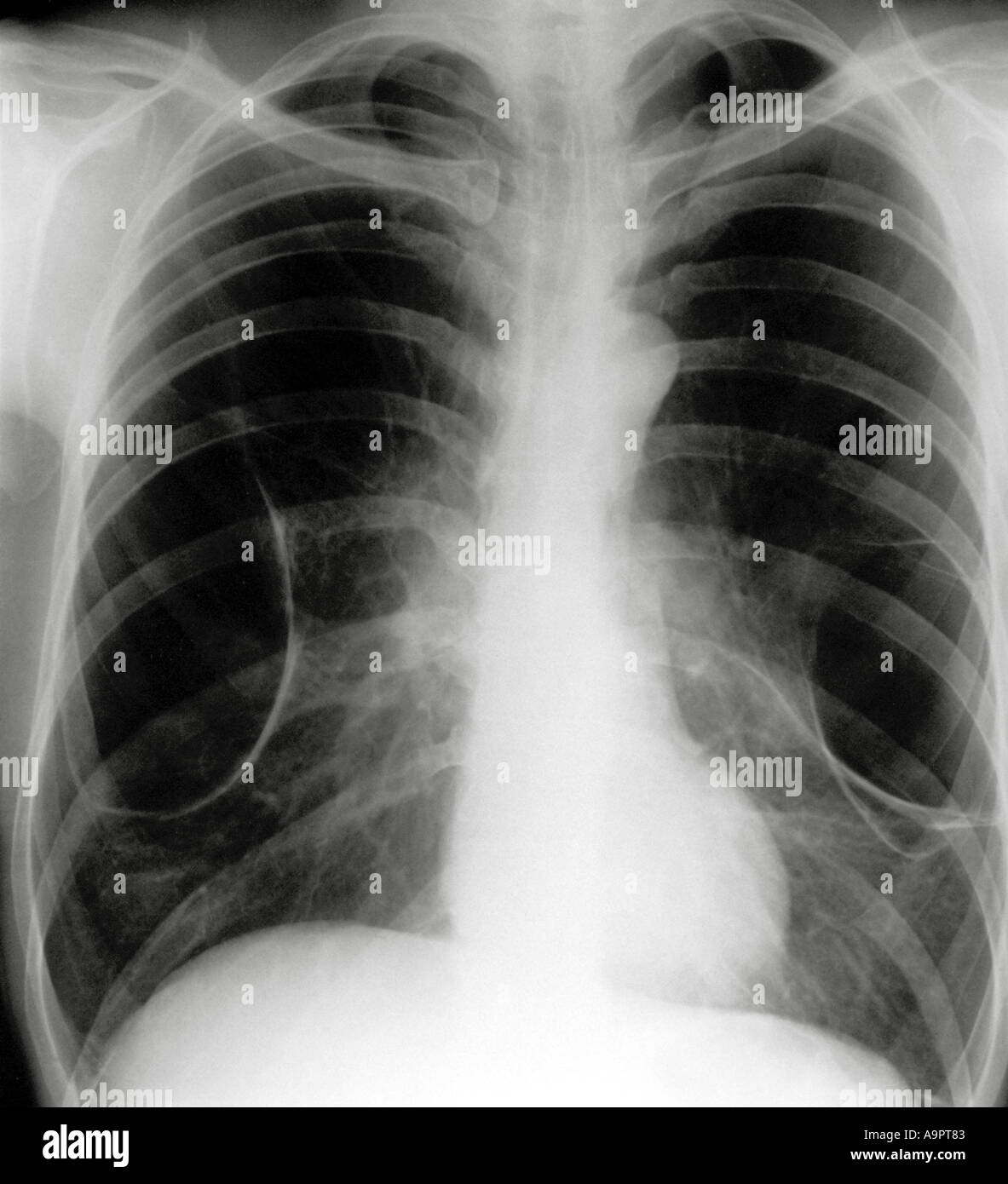 Does Copd Show Up On Xray Sharedoc