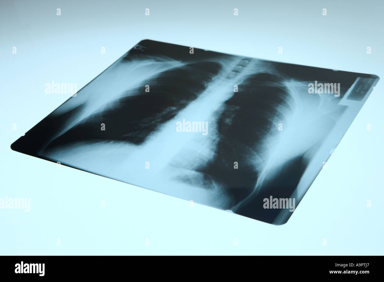Chest X Rays High Resolution Stock Photography and Images - Alamy