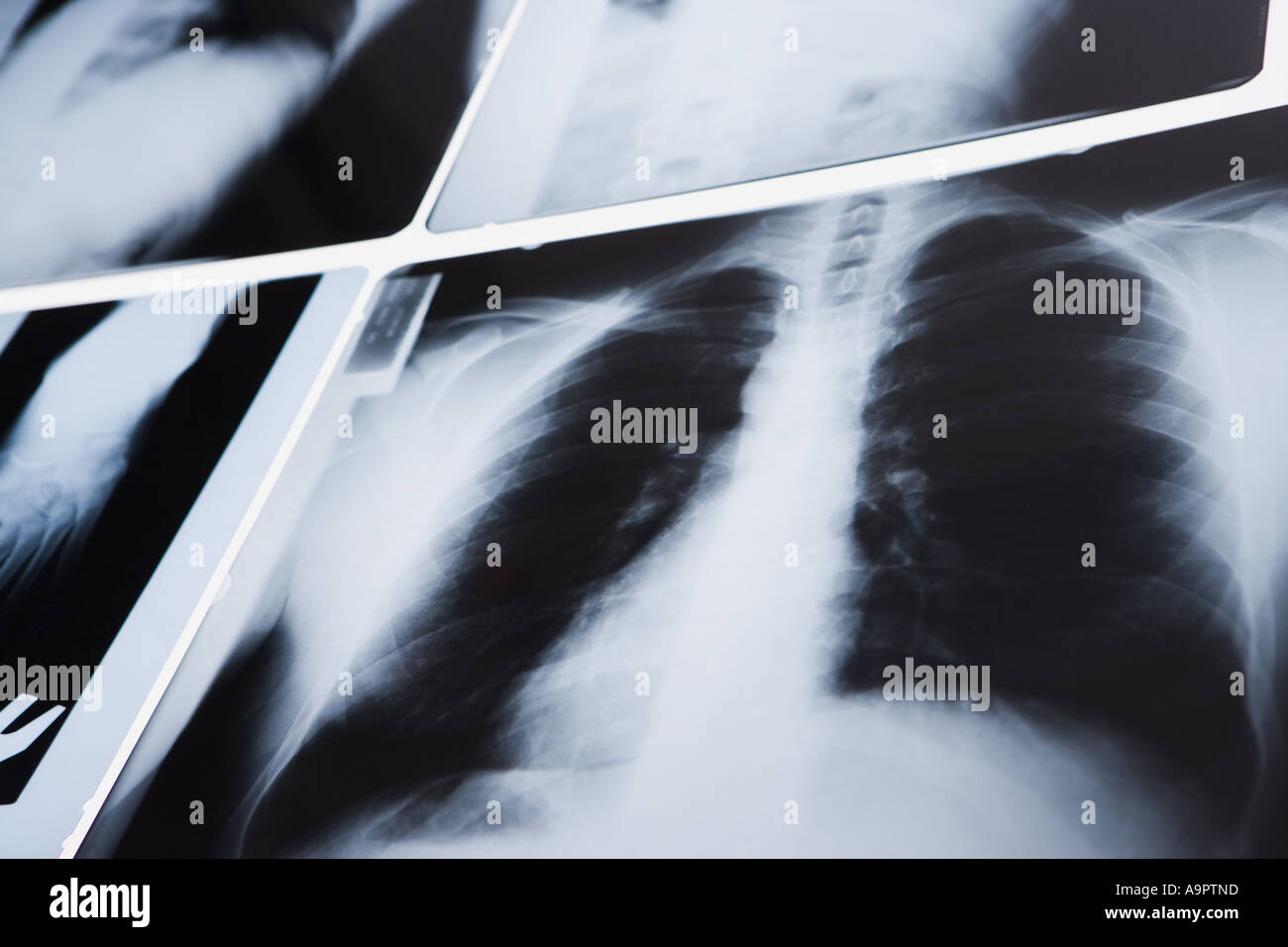 Plain x ray hi-res stock photography and images - Alamy