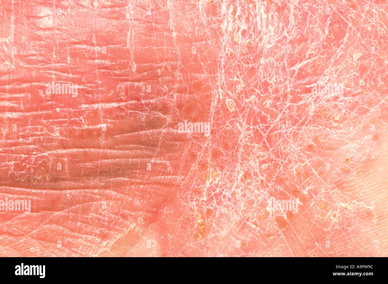 Scaling rash hi-res stock photography and images - Alamy